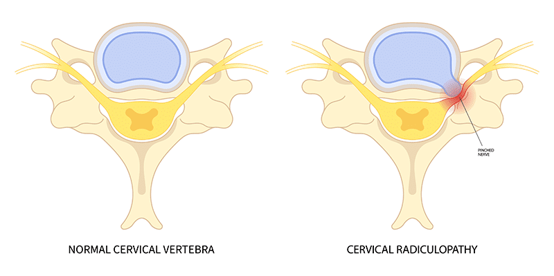 Cervical Radiculopathy Overview | Momentum Medical