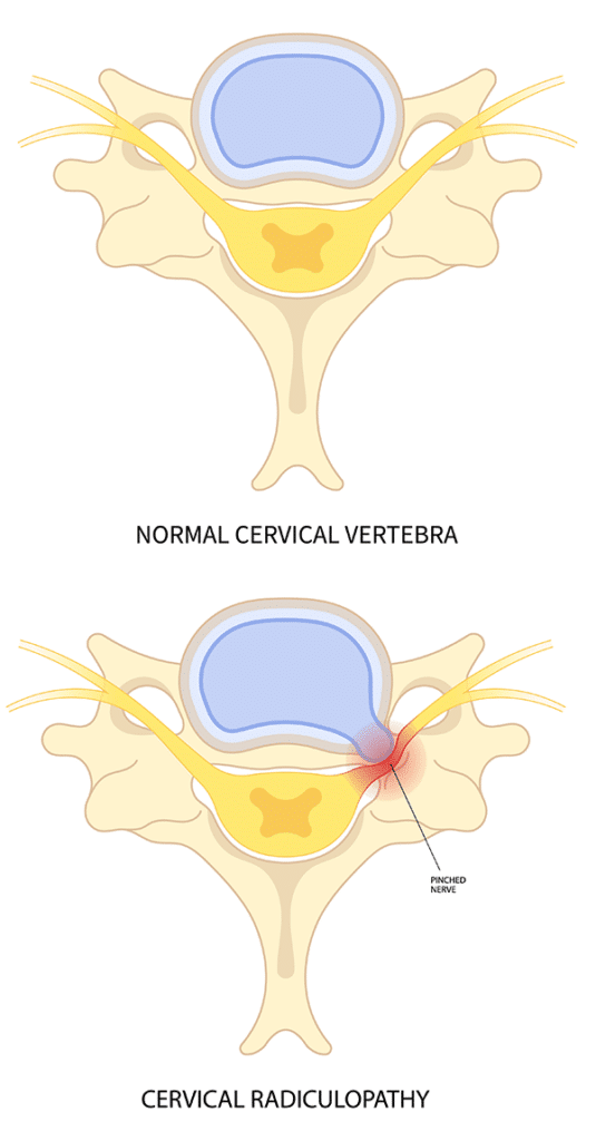 Radiculopathy: Causes, Symptoms, and Treatments
