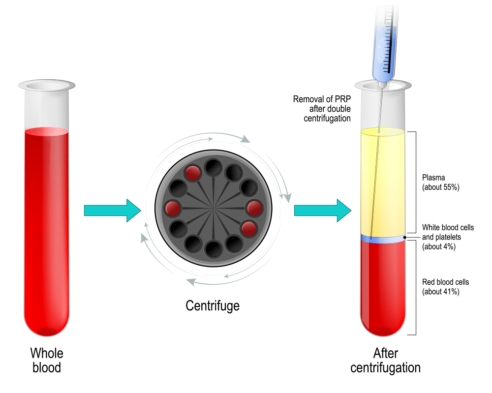 PLATELET RICH PLASMA | PRP INJECTIONS - Momentum Medical