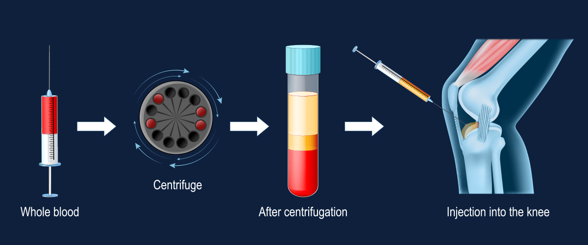 PLATELET RICH PLASMA | PRP INJECTIONS - Momentum Medical